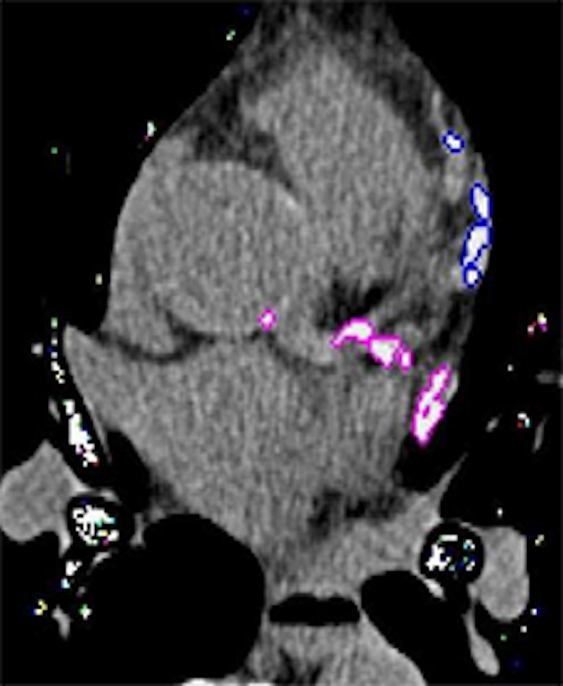 Women with diabetes and high levels of coronary artery calcium at ...
